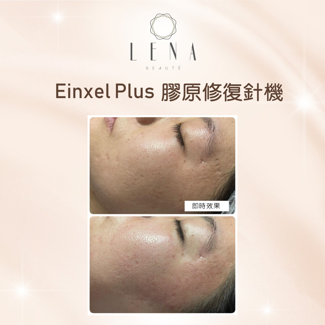 Einxel Plus 膠原修復針機
